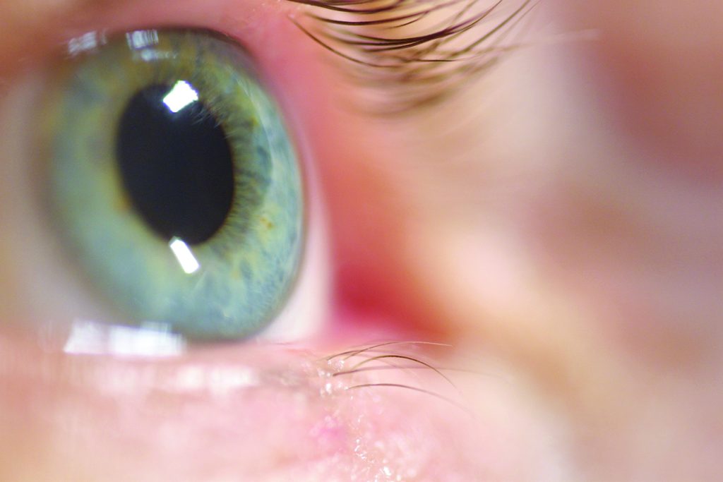 Early detection necessary to stop glaucoma progression - Herald-Standard